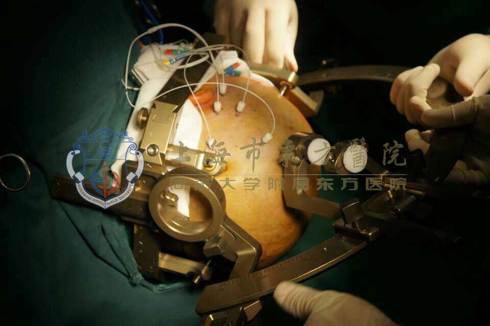 SEEG微创手术技术 让频繁癫痫消失不见_患者