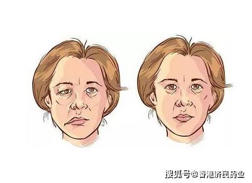 黏多糖贮积症II型新药Izcargo（Pabinafusp Alfa）中文说明书_患者