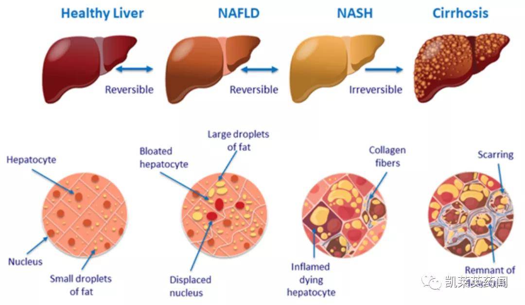 新药巡礼：Galmed携Aramchol突围NASH治疗领域_临床