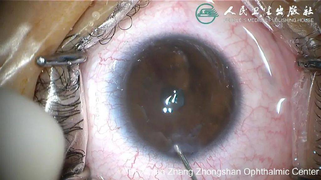 青光眼微创治疗术式：房角镜辅助的 360 度小梁切开术_导管_手术_患者