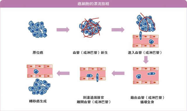 癌细胞杀手—NKT-DC免疫细胞治疗，癌症晚期也能长期生存_患者_肿瘤_疗法
