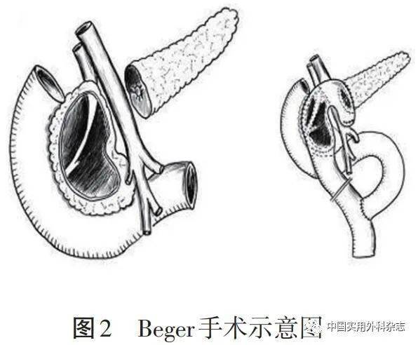 指南（共识）解读｜《慢性胰腺炎外科治疗时机国际共识》评介_手术