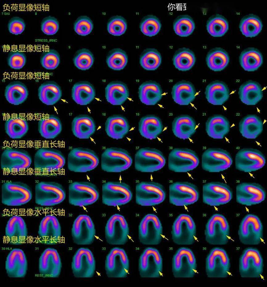 【分享】李剑明教授 | SPECT心肌灌注显像准确诊断及评价冠心病_患者