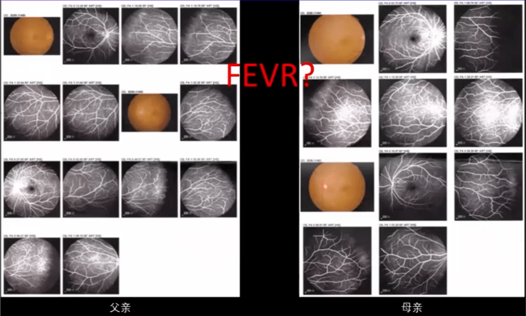 【惟视诊室】足月无吸氧史男婴，出现眼底异常血管伴周边部广泛无血管区，如何诊断？_患儿