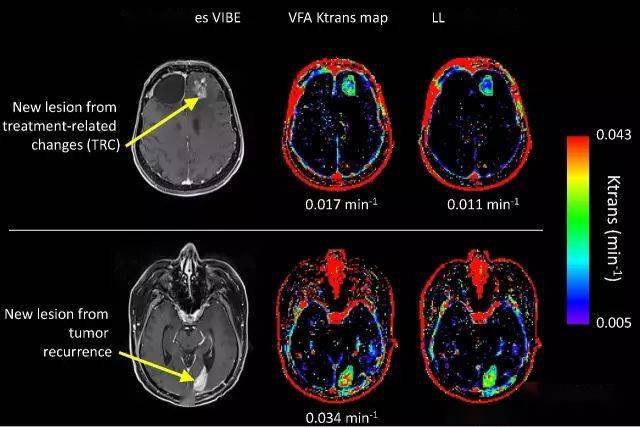 神经系统磁共振检查到底有哪些序列？都在这里_成像