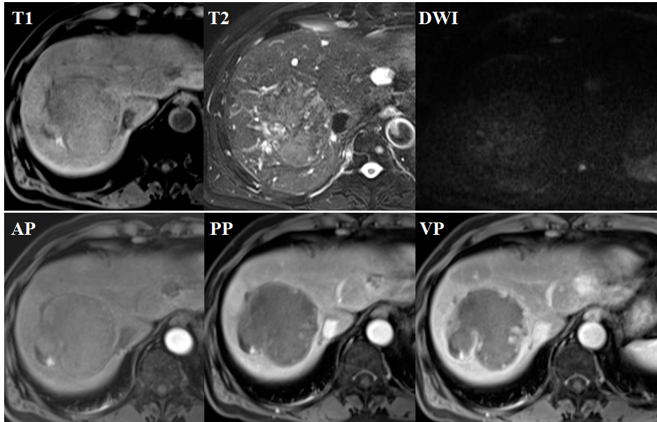 适时多次DEB-TACE治疗巨块型肝癌接近CR一例_动脉