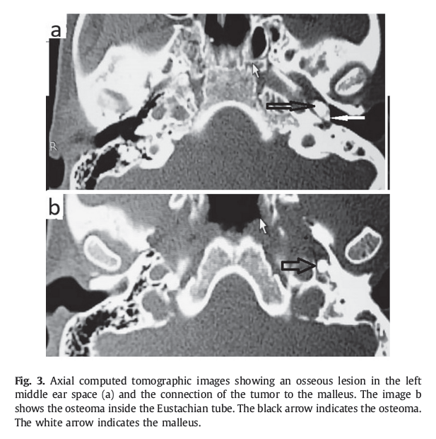Middle ear osteoma causing Eustachian tube obstruction_is