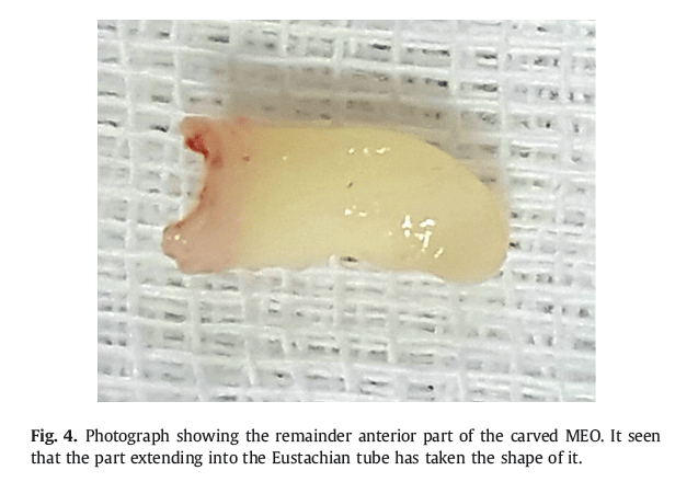 Middle ear osteoma causing Eustachian tube obstruction_is