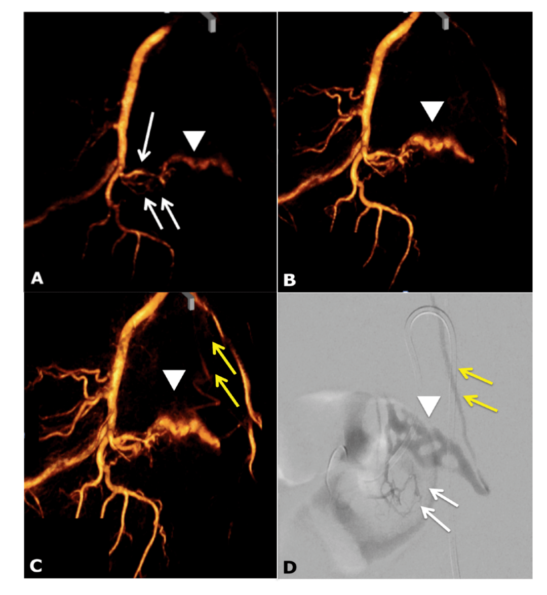 JNIS中文版丨邓剑平教授导读：4D-DSA在脊髓血管畸形诊治中应用的初步经验_动静脉