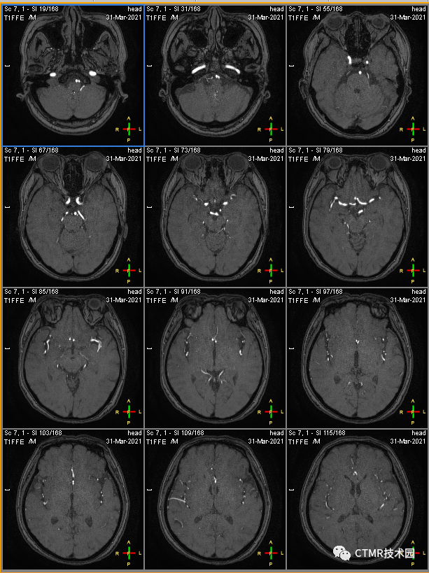 「手把手基础教程」颅脑 3D_TOF-MRA 扫描及后处理_进行