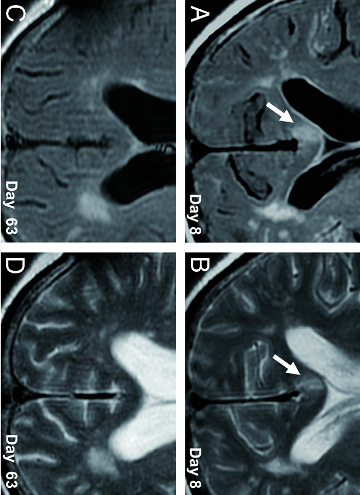 AJNR：SAH患者胼胝体DWI高信号的特征_病变