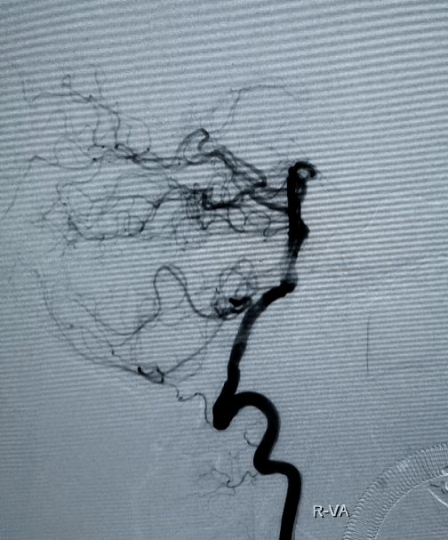中国神介500人群病例集锦第124期：野战鹰教授：Headway duo微导管助阵动脉瘤栓塞_Echelon
