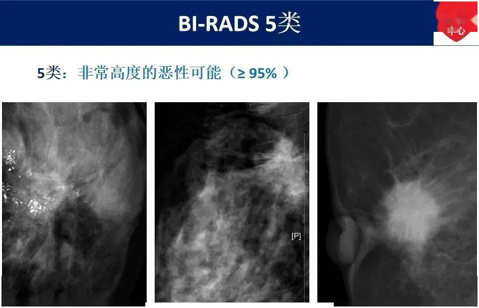 最新版乳腺X线 BI-RADS 分类解读_检查