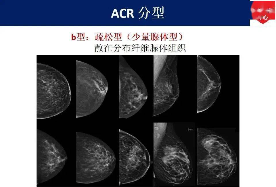 最新版乳腺x线 Bi Rads 分类解读检查