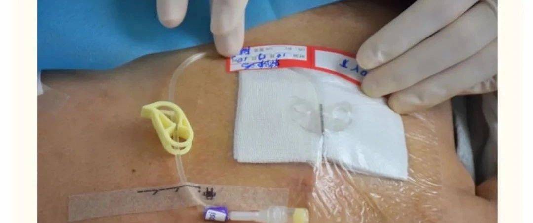 PICC，CVC，PORT一图看懂优劣势_公众