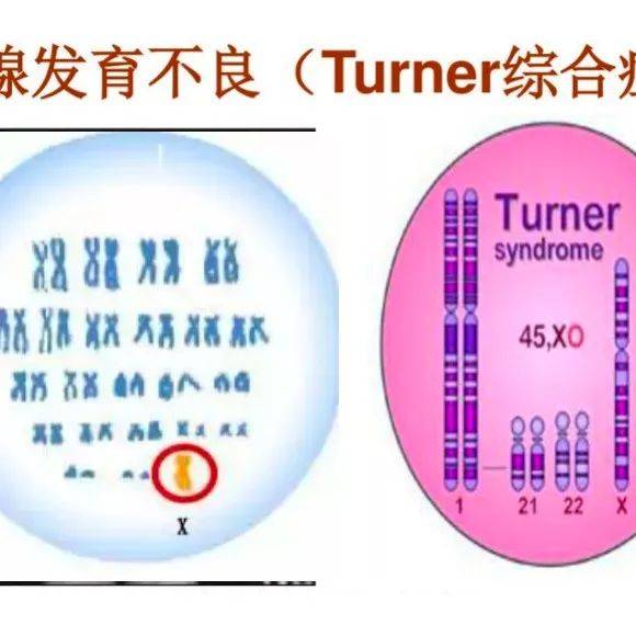 认识Turner综合征_部分