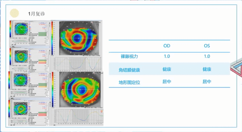 【星月谈】首期，视达佳智慧定制角膜塑形镜案例及验配心得精彩回顾_镜片_mm_医生