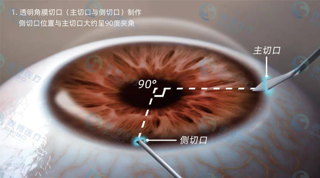图解： iTrack 内路粘小管成形术（ABiC），一种微创高效的青光眼手术_切口_眼压_导管
