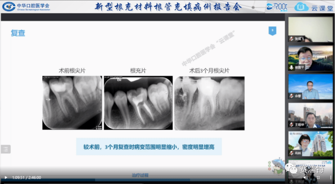中国锶·C-Root SP：让根管充填如此简单！_口腔_效果_硅酸盐