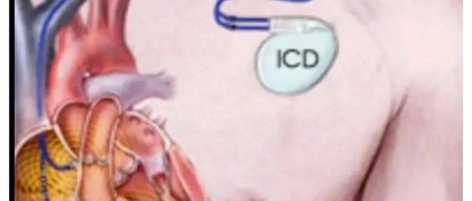 亚洲有指征的心梗患者ICD植入率低！阜外医院张澍等多国研究_中国_分层_风险