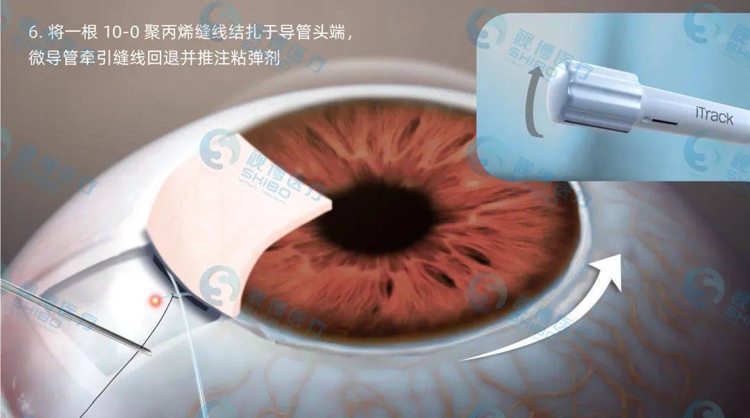 iTrack手术图解：穿透性 Schlemm′s 管成形术（PCP）_巩膜_角膜_眼压