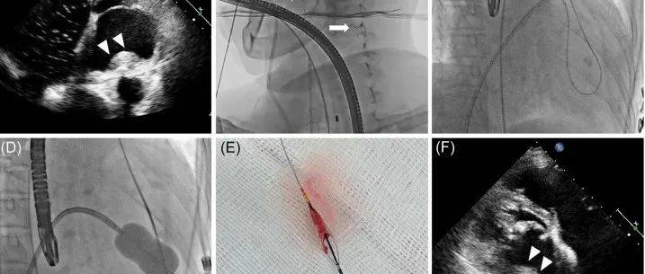 病例报道｜静脉-动脉环路和神经栓塞保护装置在二尖瓣狭窄伴血栓患者PBMV治疗中的创新应用_患者_血栓_栓塞