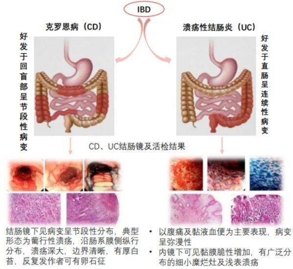 从罕见到常见，发病持续上升的IBD治疗曙光初现_相关_炎症_患病率