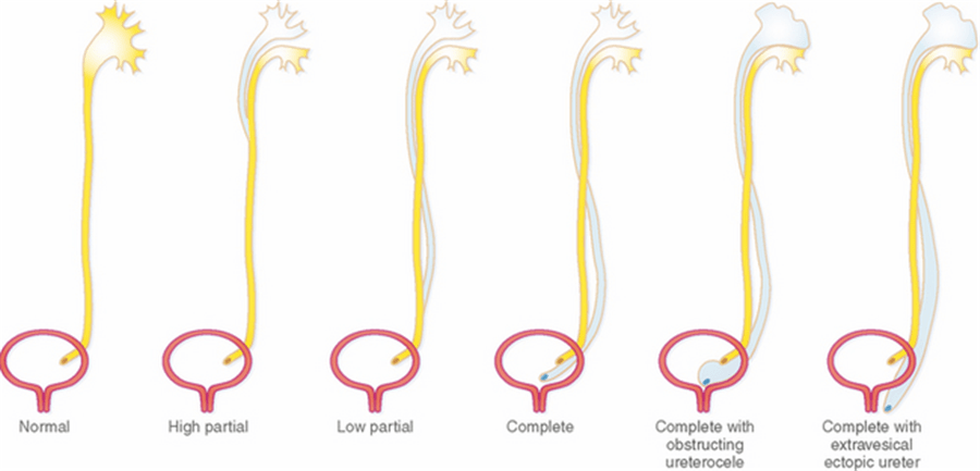 重复肾 和 Weigert-Meyer规则_输尿管_膀胱_部分