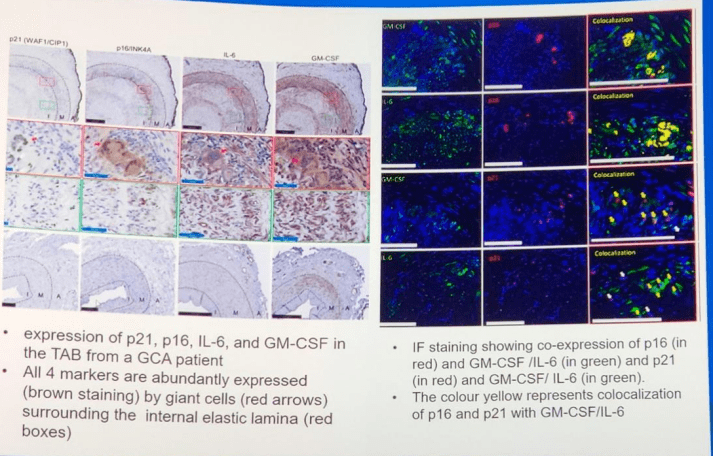 GCA疾病活动度如何预测？前沿影像学「大显身手」！_研究_患者_治疗
