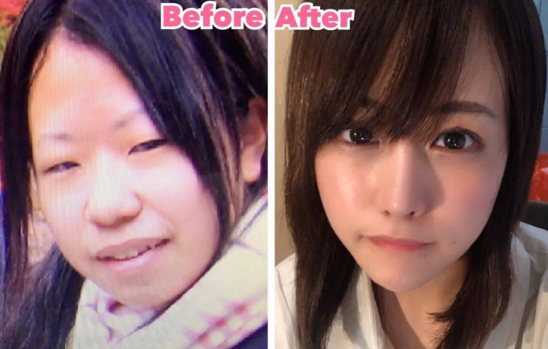 日本妹子因“太丑”遭欺凌，用400万日元整成“有村架纯”！_Mikishi_整形_生活