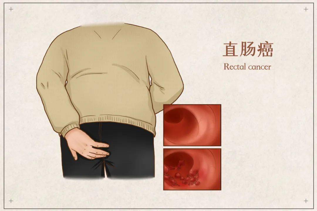 直肠癌”、 痔疮”,别在傻傻分不清楚治疗患者肛肠