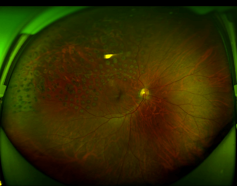 探索功能性IOL“新大陆”：Vivity IOL在玻切术后并发性白内障中的应用_患者_视觉_右眼